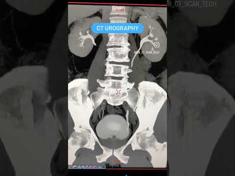 CT Urography MIP #shorts #youtubeshorts #viral