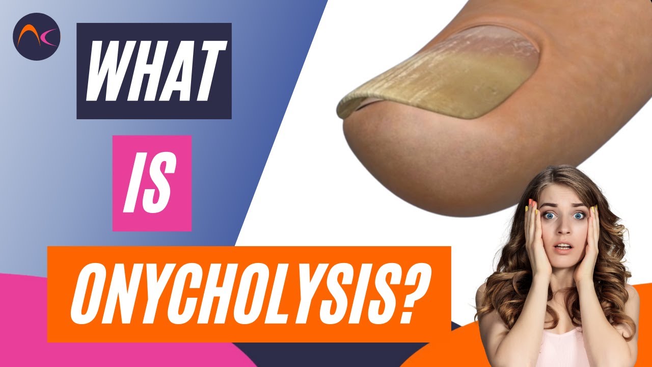 What is Onycholysis? Nail lifting and Separation Explained!