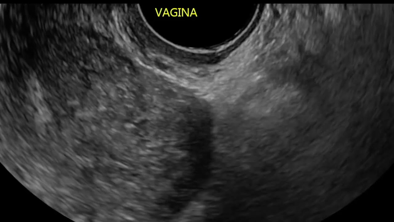 Video 5: Normal vagina