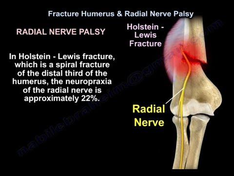 Humerus Fracture with Radial Nerve Palsy and Wrist Drop – Diagnosis and ...