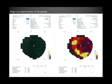 Stargardt Macular Dystrophy Treatment Proof – Visual Field Tests Results
