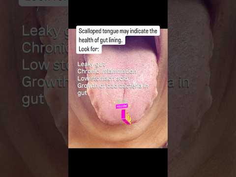 Scalloped tongue- indented tongue edges