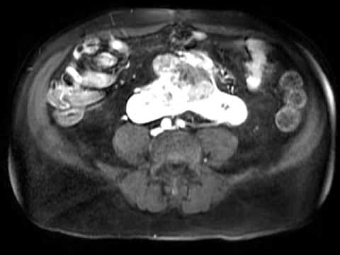 Renal Cell Carcinoma in Horseshoe Kidney