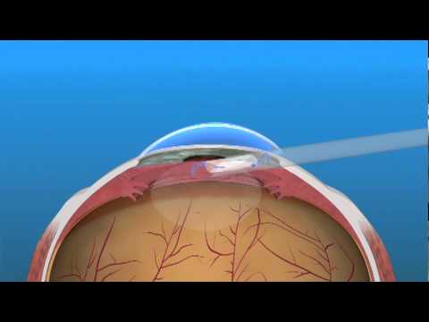 Toric Contact Lenses at Best Price in India