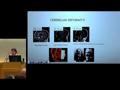 "Cerebrospinal Fluid Pathologies" - Petra M. Klinge, MD, PhD