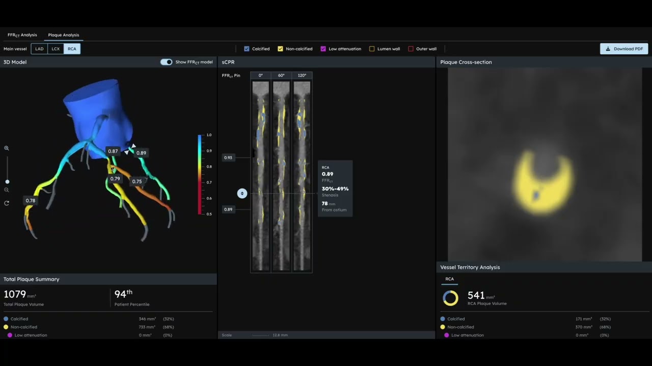 CCTA with HeartFlow AI: Basic Introduction (Plaque, Stenosis & FFR)