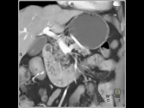 Adenocarcinoma Duodenum 3
