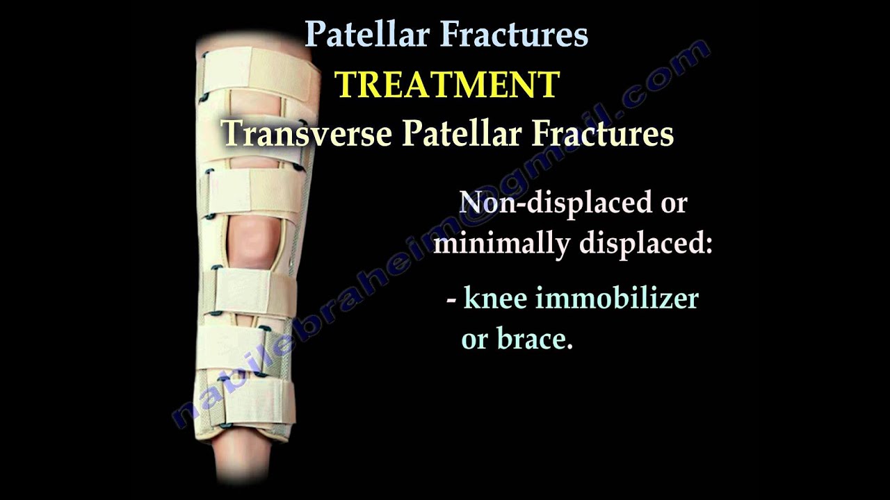 Patellar Fractures - Everything You Need To Know - Dr. Nabil Ebraheim