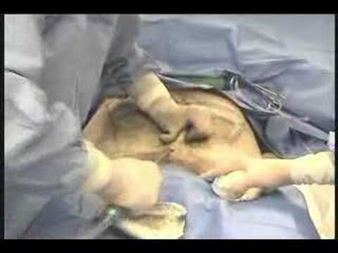 Abdominal Etching: Liposculpturing the Athletic Abdomen.