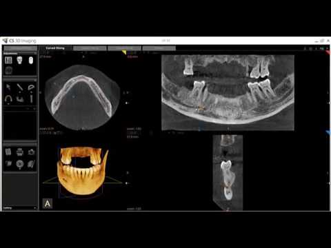 CS 3D Imaging Mapping Mandibular Nerves