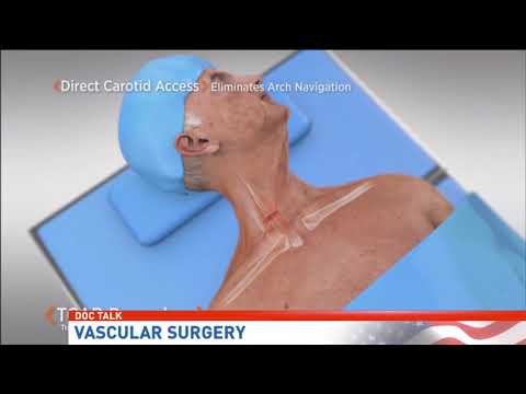 Doc Talk | New procedure for vascular surgery