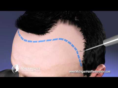 NeoGraft Michigan Hair Restoration 844-4-HAIR-NOW