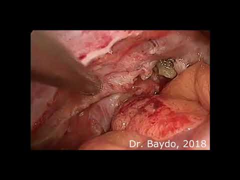 Laparoscopic ureter reimplantation