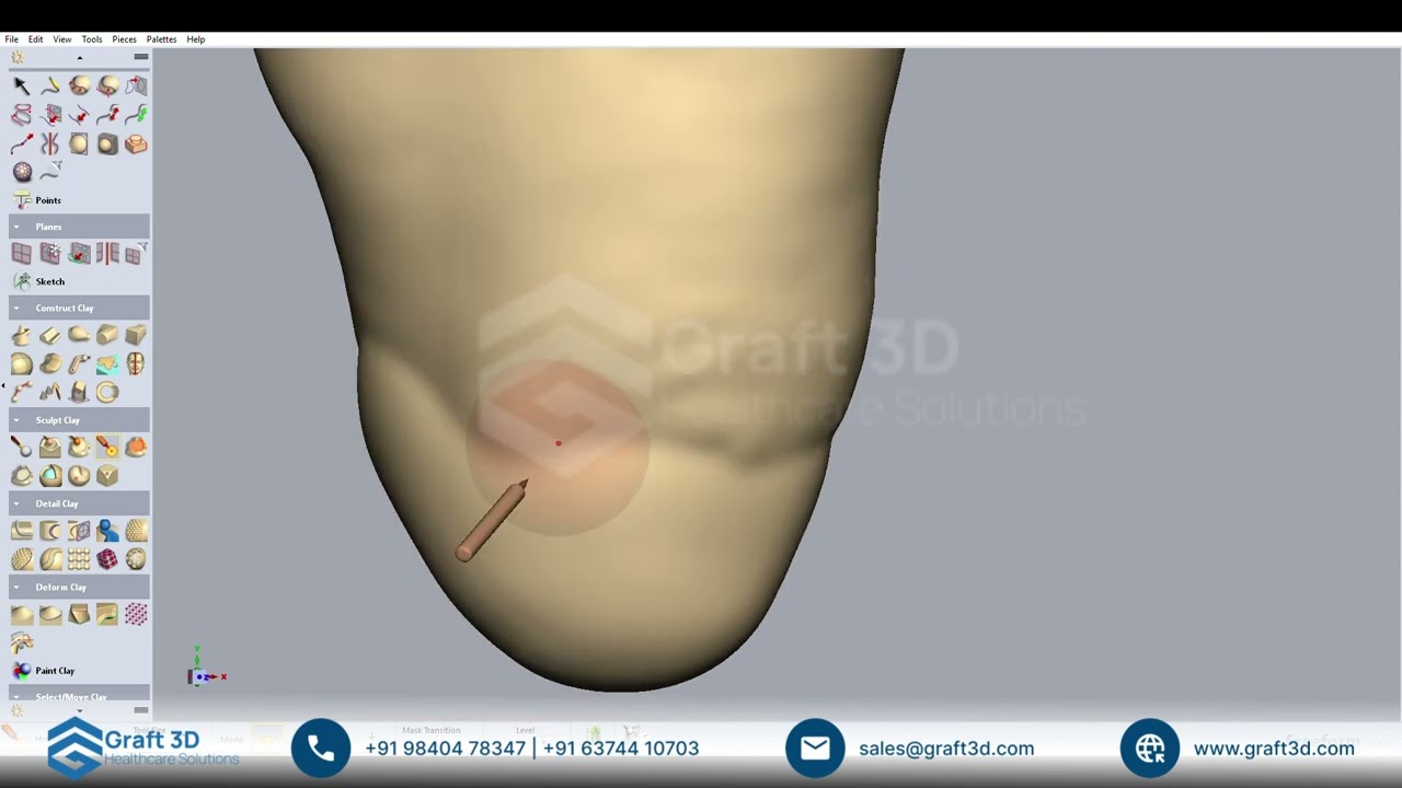 Designing  Above-Knee (Transtibial) Prosthetic Socket Using Geomagic Freeform | Graft3D P&O Workflow