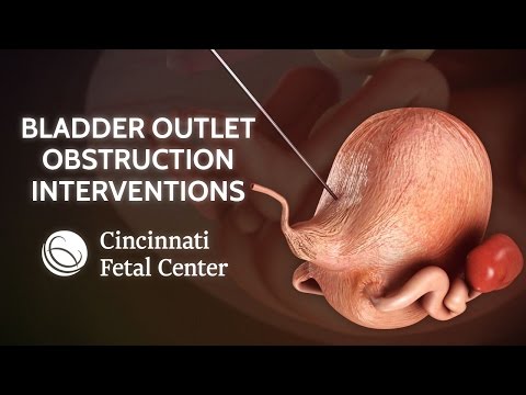 Bladder Outlet Obstruction Interventions | Cincinnati Fetal Center