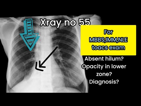 OPACITY IN RIGHT LOWER ZONE OF LUNG|CHEST XRAY OF OPACITY IN RIGHT LUNG|LUNG CANCER|LUNG COLLAPSE
