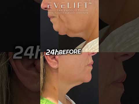 EVE Lift™ Weekly Recap | Eden Plastic Surgery: Dr. Ali Charafeddine, MD | Miami, FL