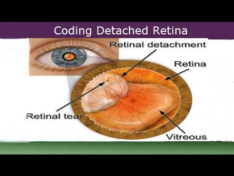 Medical Coding Detached Retina — Coding Diabetes Code 361.9 and 250.51