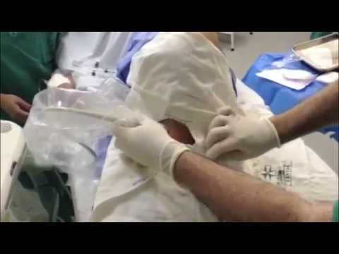 Interescalene Block Catheter Ultrasound