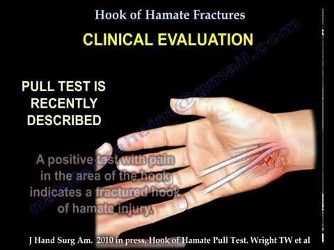 Hook of Hamate Fracture - Hand - Orthobullets