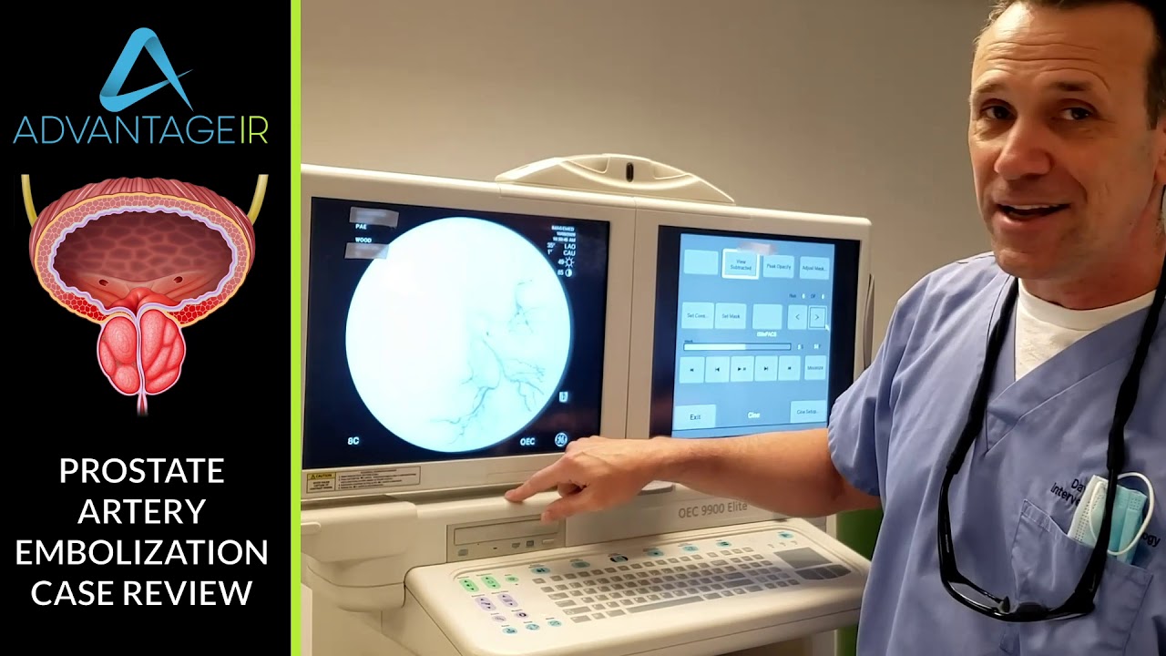 Prostate Artery Embolization Case Study