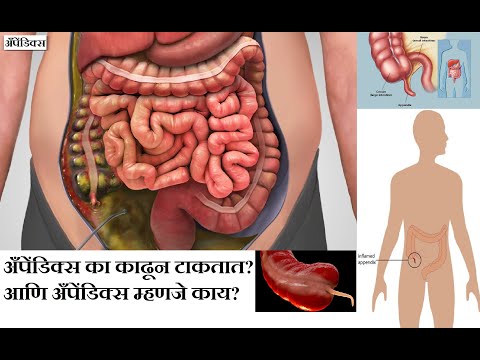 अँपेंडिक्स का काढून टाकतात आणि अँपेंडिक्स म्हणजे काय?