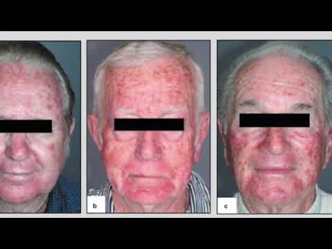 5-Fluorouracil (Efudex) Instructional Video