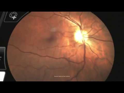 Introducing the WELCH ALLYN RETINAVUE 700 Imager