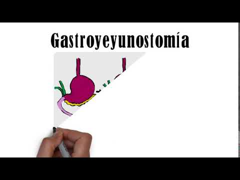 Spanish Medical Interpreter - Spanish Medical Terminology - How to say Gastrojejunostomy in Spanish?