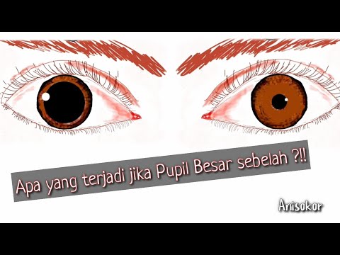 Pupil besar sebelah, Anisocoria