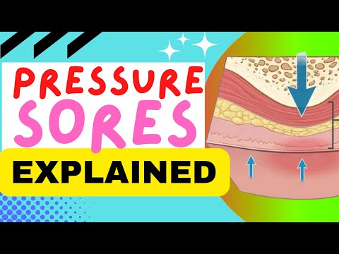 PRESSURE SORES EXPLAINED - CAUSES, STAGES, MANAGEMENT, TREATMENT - PRESSURE ULCERS AND BED SORES