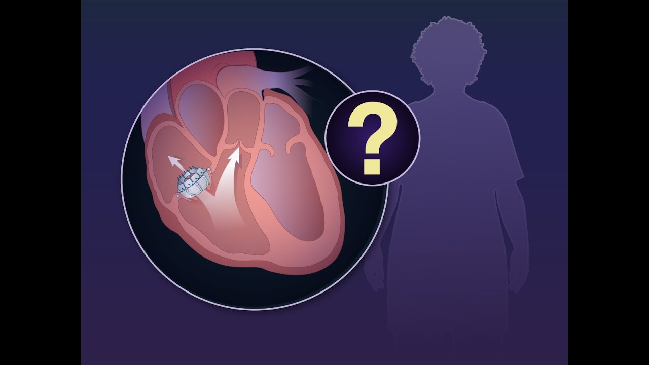 Transcatheter Valve Replacement in Tricuspid Regurgitation | NEJM
