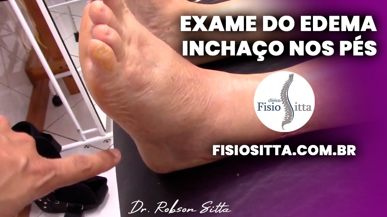 EDEMA SWELLING EVALUATION EXAM CAFIFO or GODET SIGN + STEMMER TEST Physiotherapy Dr. Robson Sitta