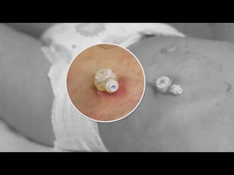 G-Tube - Managing Redness and Irritation - Stanford Medicine Children's Health