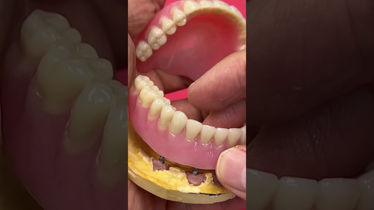 Overdenture with Mini Implants