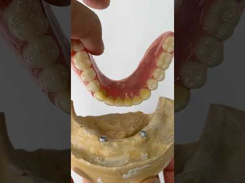 Metal Mesh Locator Denture #dental #teeth #smile #dentures #denture #lsk121shorts #shorts#shortvideo