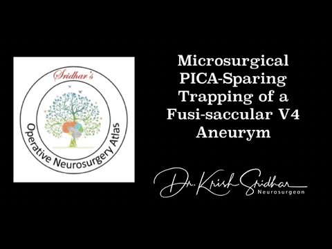 PICA SPARING TRAPPING OF A FUSI-SACCULAR ANEURYSM OF THE V4 SEGMENT OF THE VERTEBRAL ARTERY