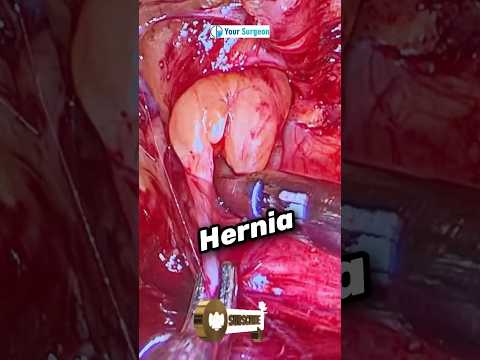 REAL HERNIA In REAL LIFE kaisa dikhta hai ?operation ke time HERNIA HOLE I ACTUAL HERNIA DEFECT SIZE