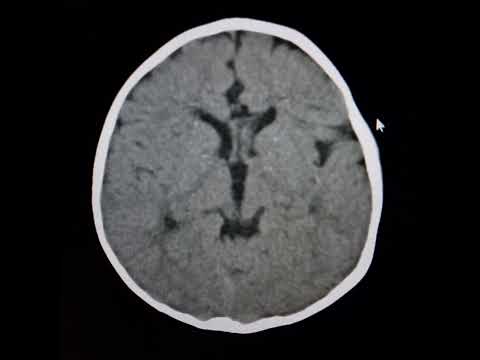 Mild cerebral atrophy +dystrophic calcifications of white matter.