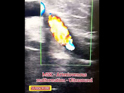 Musculoskeletal Arteriovenous malformation - Radiology Analysis