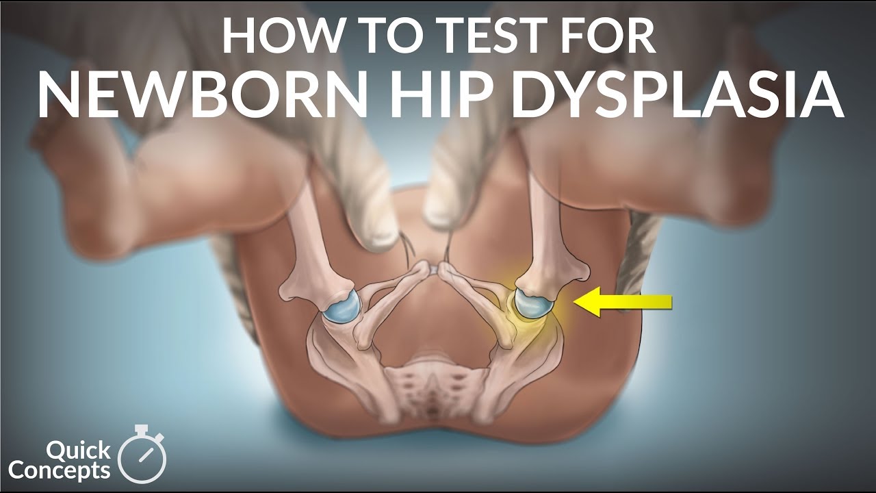 How to Test for Newborn Hip Dysplasia by N. Gold | OPENPediatrics