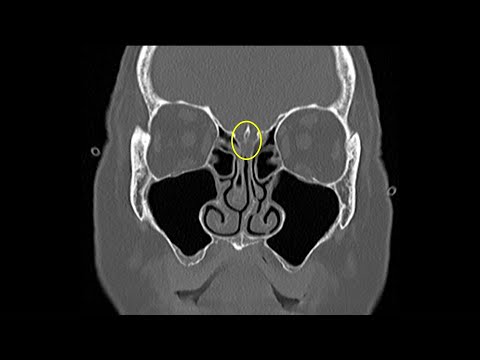 Midline Meningocele