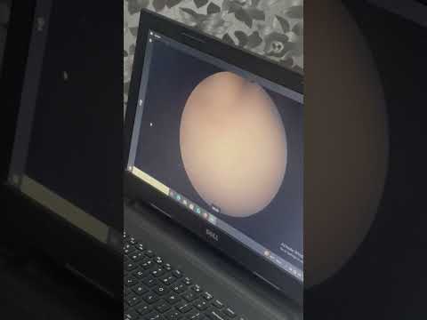 Nasoendoscopy. 10 year child with nasal obstruction.Gross DNS.#ent #doctor #challenge #viralvideo