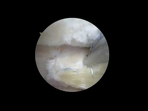 An Alternative Method of Meniscus Root Tear Fixation with Biologic Augmentation: Part 2