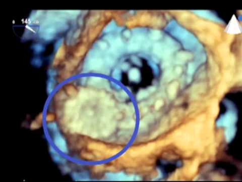 Paravalvular Leak Closure Using Transapical Approach at Holy Cross Hospital, Fort Lauderdale, FL
