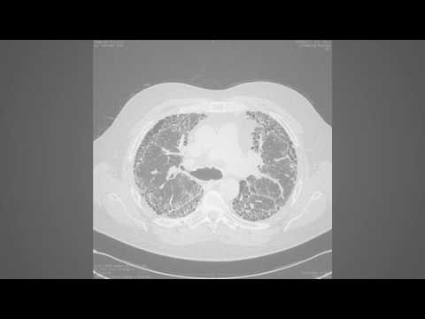 Axial chest high-resolution CT scan in a patient with idiopathic pulmonary fibrosis