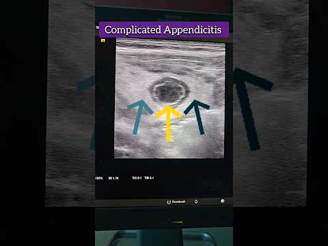 Complicated Appendicitis 💯❤️ #medical #ultrasound #infection #health #education #knowledge #shorts