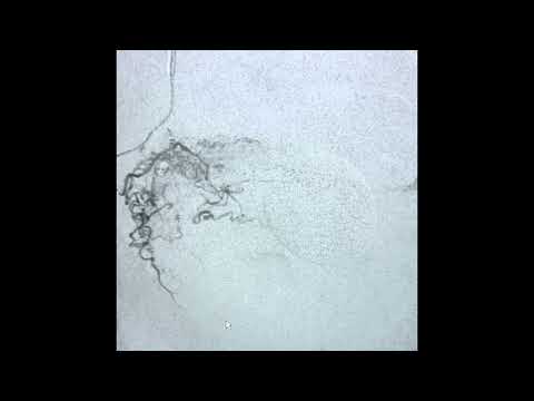 Prostate artery embolization(PAE) by irdocnigeria