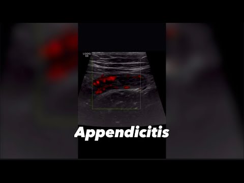 Appendicitis Short
