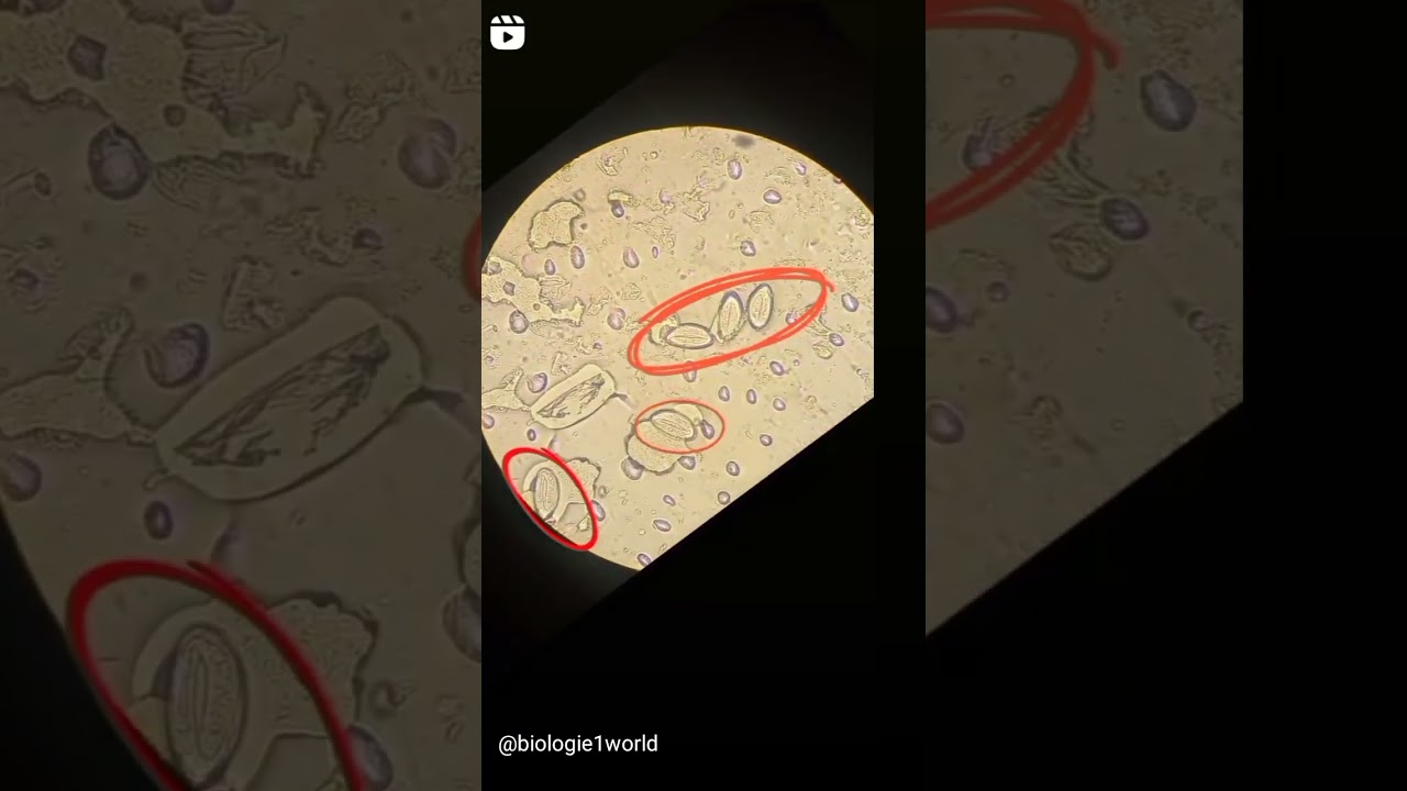 Identifier et prévenir une infestation d'oxyures : guide pratique